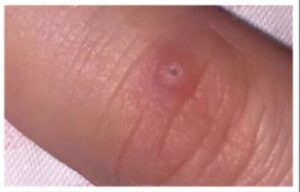 Hvad er en Vorte? Guide til typer, årsager & fjernelse