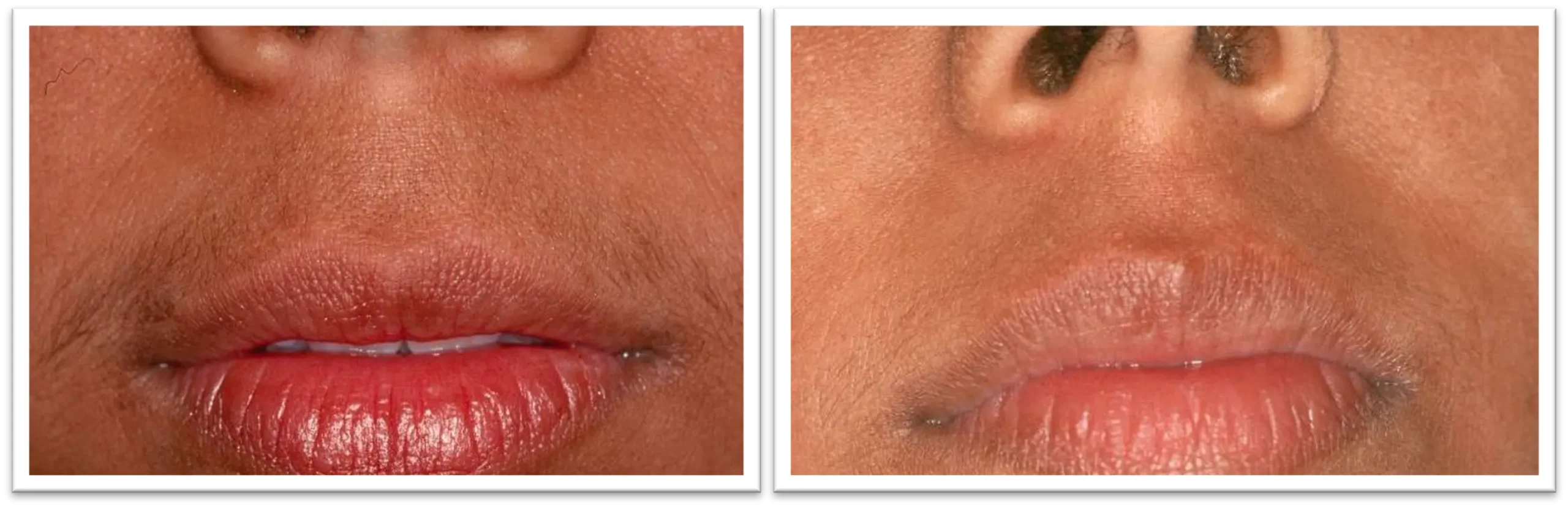 Fordele og ulemper ved permanent hårfjerning