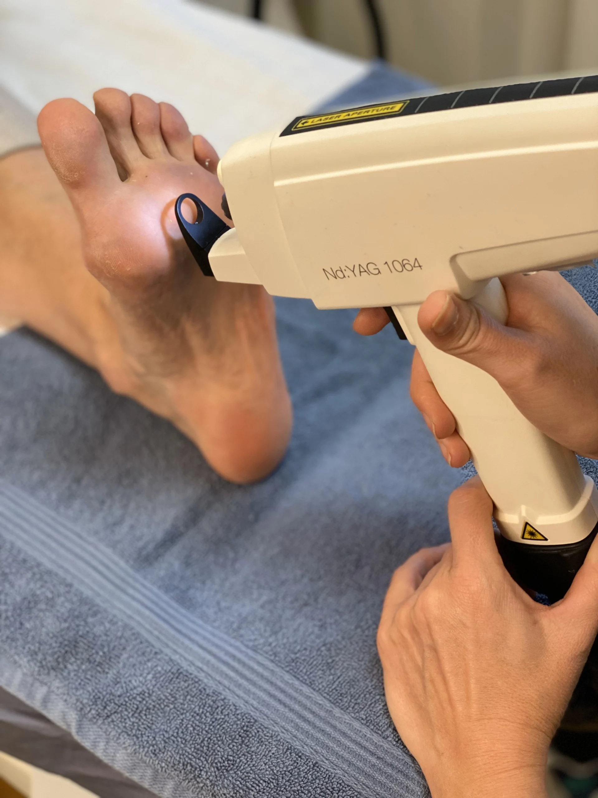 Nem behandling af vorter med laser | Hellerup Laserklinik